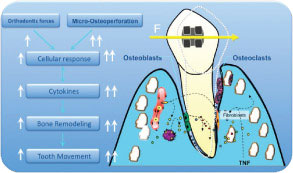 Propel - Fast Braces Lakewood | Brodsky Orthodontics