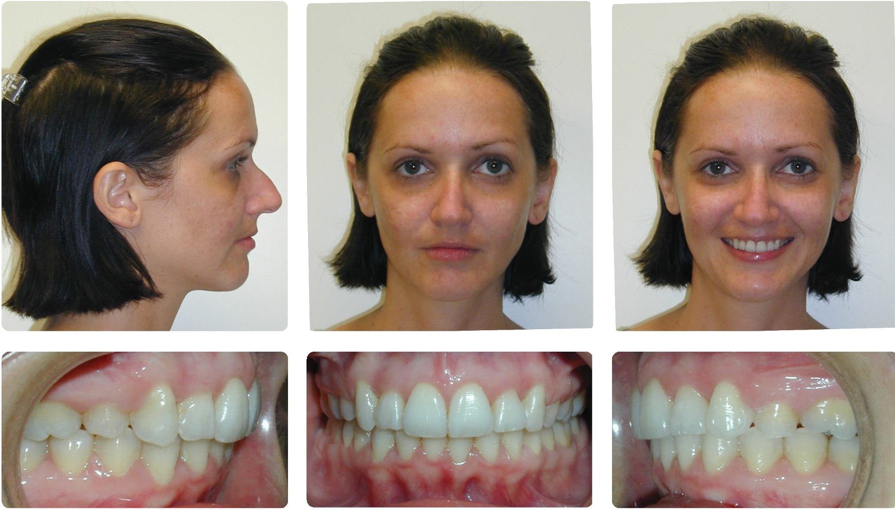 Overbite Correction Before And After Pictures