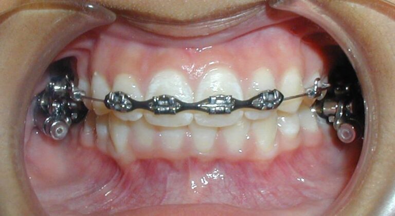 Types of Orthodontic Appliances | Lakewood Braces | Brodsky Orthodontics